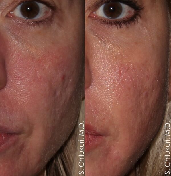 Exosomes In Houston Refresh Dermatology
